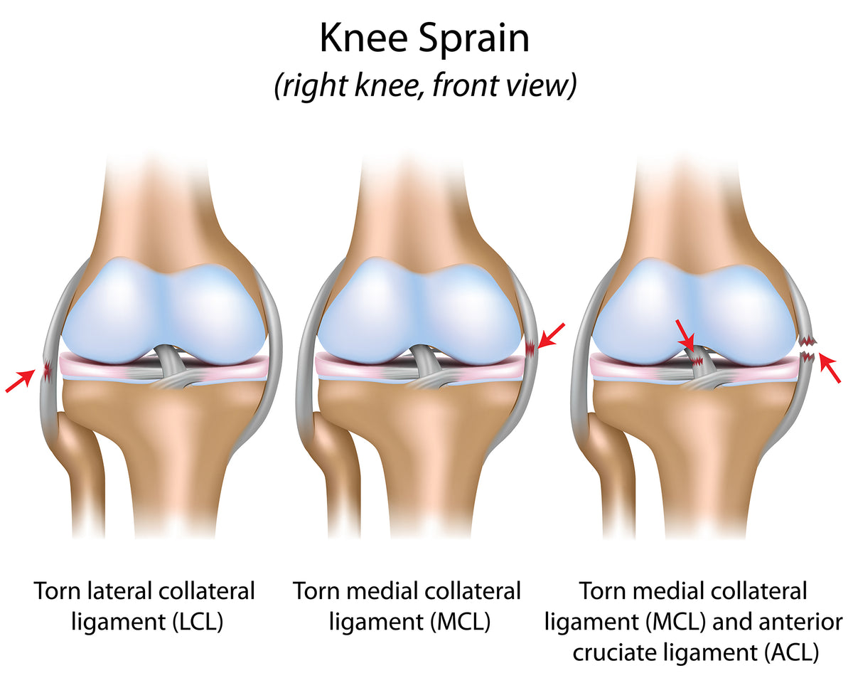 MCL Injury Treatment Guide – Sacksy Thyme